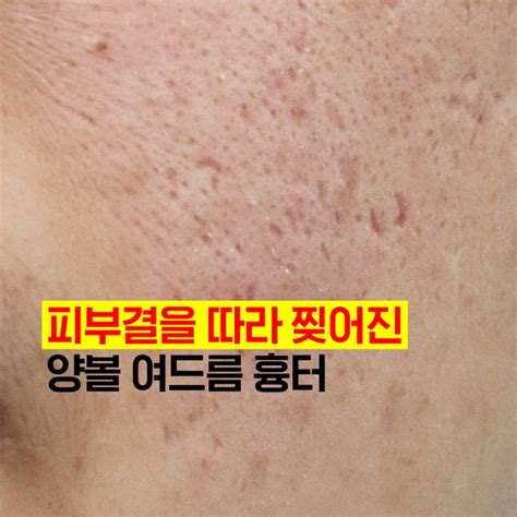 부산여드름흉터치료 양볼의 박스카와 찢어진 아이스픽을 치료한 케이스입니다 로담한의원 새살침 7회 20230317~20240116 네이버 블로그