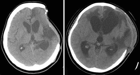 Computed Tomography Images Showing Mild Hydrocephalus With Bifrontal