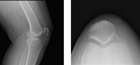Condroplastia Patelofemoral Y Meniscectomía Medial Parcial