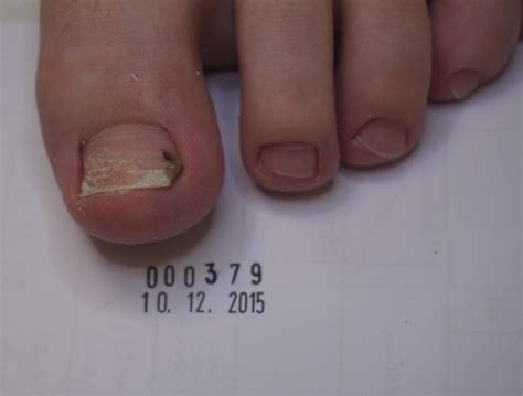 Ziarnina Archives Gabinet Podologiczny Podologia Gorzów Wlkp