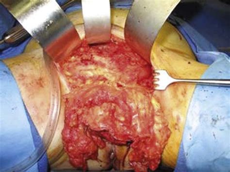 Radical Vulvectomy With Tunnel Groin Dissection Clinical Gate