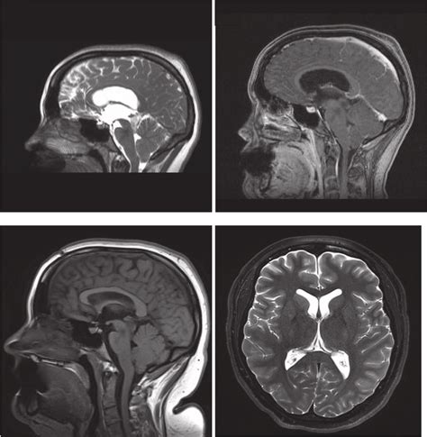 Preoperative Mri Images A Mri Sagittal T2 Weighted Image Without