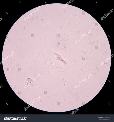 Photo De Stock Dysmorphic Red Blood Cells Urine 335460272 Shutterstock