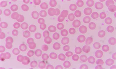 Differential Diagnosis Thrombocytosis