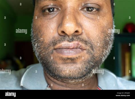A Cold Sore On The Lip Of A Middle Aged Male A Middle Aged Mans Lips