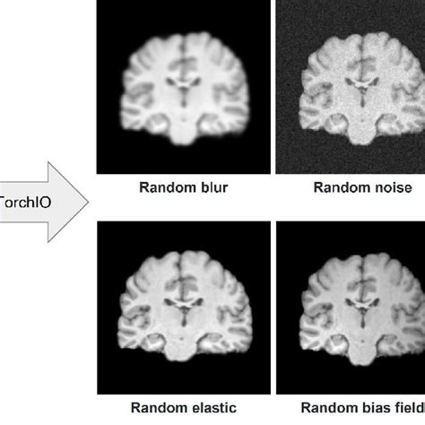 An Example Of 3d T1 Weighted Mri Data Augmentation Results In The Download Scientific Diagram