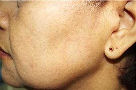 Figure 4 From Actinic Granuloma With Focal Segmental Glomerulosclerosis Semantic Scholar