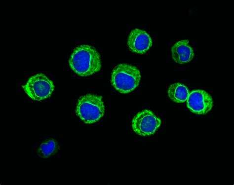 Tumour Infiltrating Lymphocytes Can Be Used In Breast Cancer Diagnosis