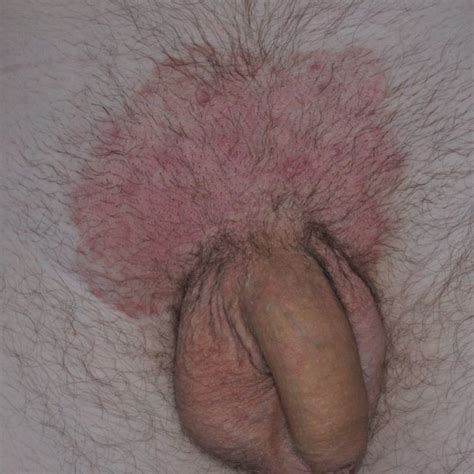 Erythematous Scaling Plaques And Follicular Pustules In An 18 Year Old