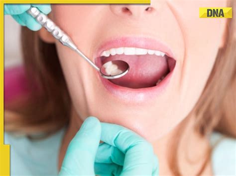 Oral Cancer Are You At Risk Warning Signs And Symptoms Of Mouth Cancer