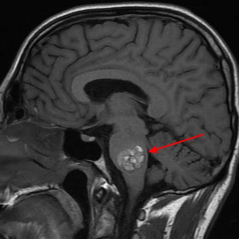Cavernous Malformation Cause Brain Stem Symptoms Treatment