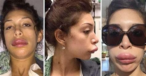19 Lip Injections Gone Horribly Wrong