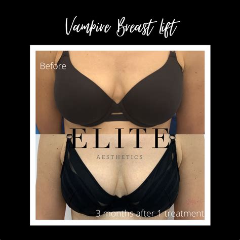 Vampire Breast Lift London Non Surgical Prp Breast Lift Uk Elite