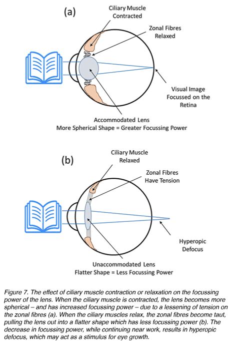 Diopter Myopia At Nancy Milne Blog