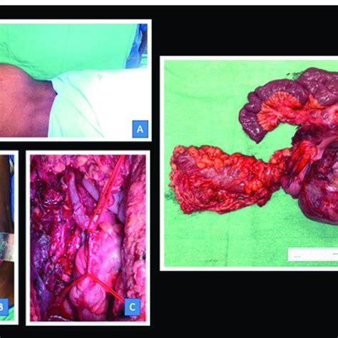 Gist A Preoperational Image Showing Abdominopelvic Lump In Lateral Download Scientific