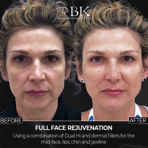 Non Surgical Full Face Aesthetic Treatments Drbk Clinics