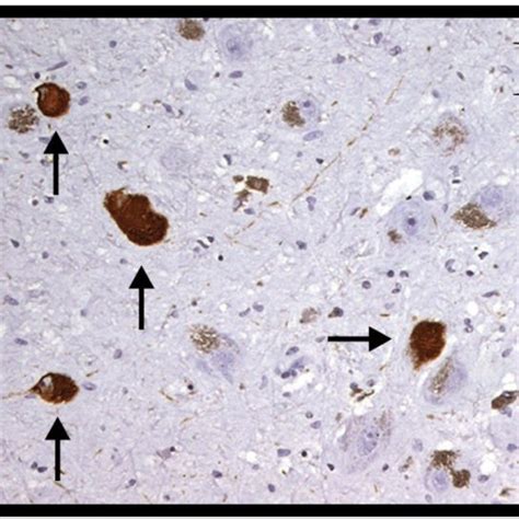 Immunostaining For Hyperphosphorylated Tau At8 In Case 1 A There Download Scientific
