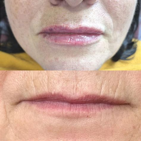 КОСМЕТОЛОГ ІРИНА ГУБИ ГОЛОСІЇВСЬКИЙ КИЇВ 👄 Порівняння які всі дуже люблять дивитись але