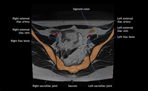 Ct Anatomy Of Hip Bone At Leslie Perry Blog