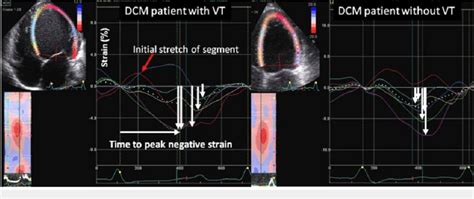 Figure Showing Longitudinal Myocardial Deformation In Patient With Download Scientific Diagram