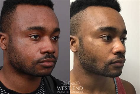 Liposuction And Buccal Fat Pad Removal Before And After Gallery Case 9367