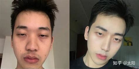 几年的黑眼圈怎么去掉 知乎