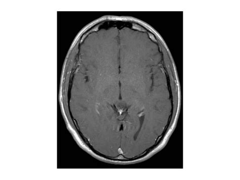 Diagnostic Imaging Of Pineal Region Masses