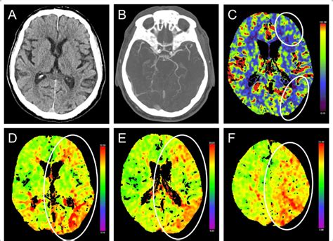 Ncct Cta And Ctp Of Patient 2 Exemplary Cuts Of First Ncct A Cta Download Scientific