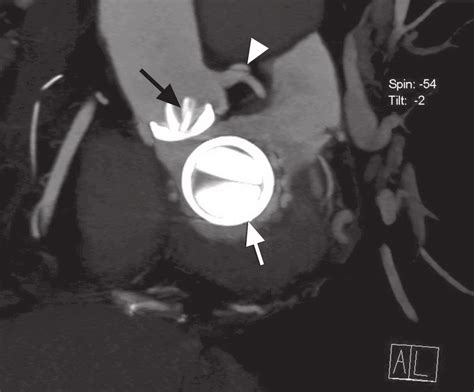 Contrast Enhanced Cardiac Computed Tomography Reconstructed Short Axis