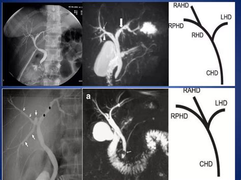 Gall Bladder And Biliary Tract Anomalies And Variants Pptx