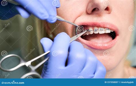 Orthodontist Placing Braces On Patient Teeth Stock Image Image Of Tool Medical