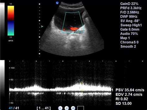 Color Doppler And Spectral Waveform Of A Normal Ureterovesical Jet
