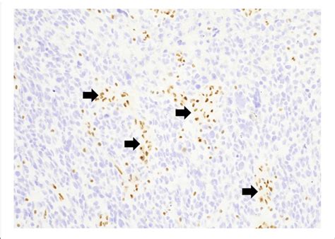 A Glioblastoma With An Atrx Mutation Demonstrating A Loss Of Download Scientific Diagram