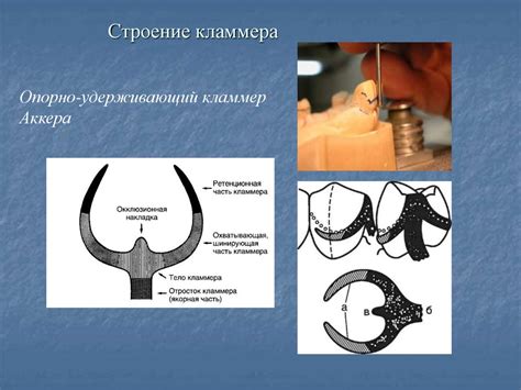 Нанесение границ каркаса бюгельного протеза презентация онлайн