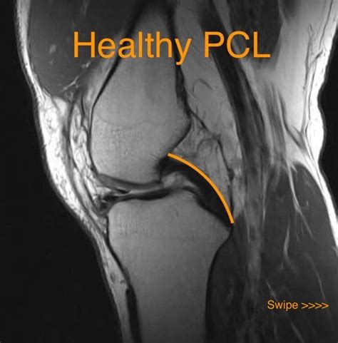 Normal Mri Of A Healthy Posterior Cruciate Ligament Pcl Anatomy Images Cruciate Ligament