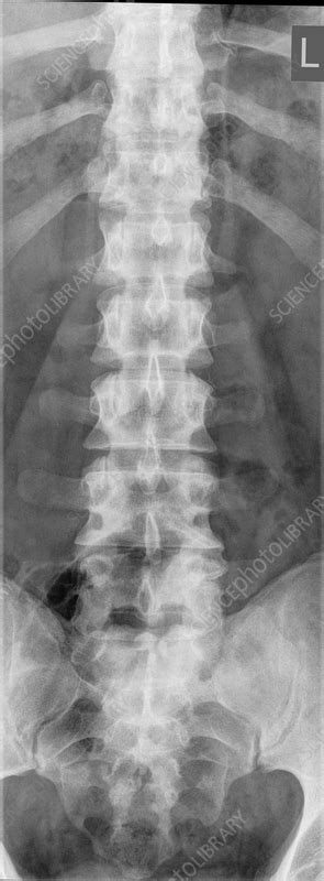 Lumbar Spine X Ray Stock Image C056 4201 Science Photo Library