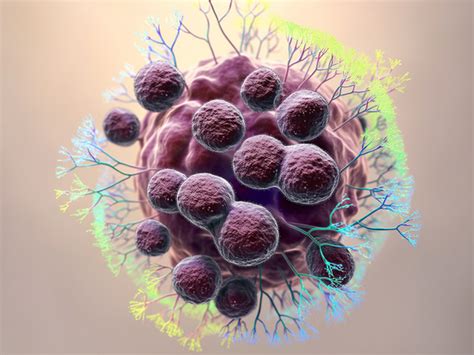 舌鳞状细胞癌最新治疗方法有哪些 舌鳞状细胞癌 舌癌 肿瘤疾病大全癌症肿瘤科普知识 有来医生