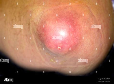 Infected Bursitis Of The Elbow Close Up Of The Elbow Of A 70 Year Old Male Patient Affected By