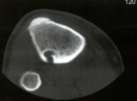 第十二节 纤维性骨皮质缺损 外科学 医学