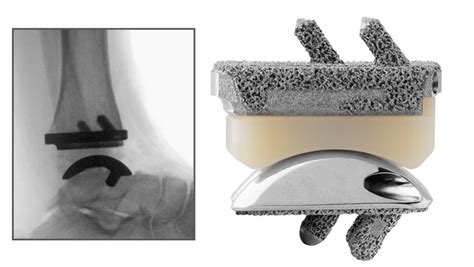 Ankle Replacement A Comprehensive Guide Martin Klinke London Foot