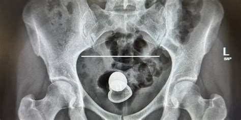 ‘unfortunate Sex Mishap On First Date Leaves Porn Star In The Hospital