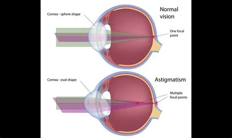 Astigmatism Symptoms Causes Diagnosis And Unknown Facts
