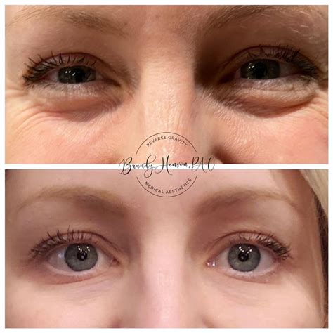 Botox Reverse Gravity Medical Aesthetics Redlands Ca