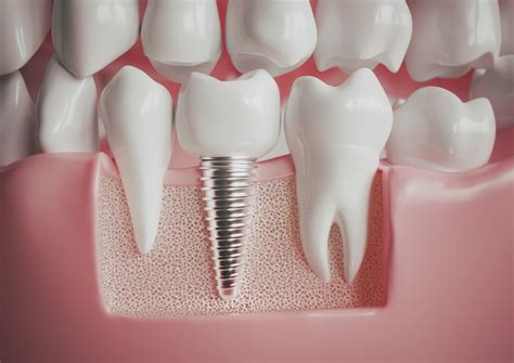 Quelle est la durée de vie dun implant dentaire