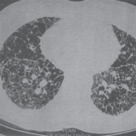 High Resolution Ct Thorax Revealed Thin Walled Cystic Spaces In Both