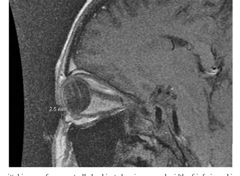 Figure 3 From Mri Findings Of Orbicularis Oculi Hypertrophy Due To