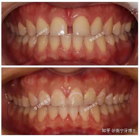 牙缝太大，吃东西老塞牙怎么办？ 知乎