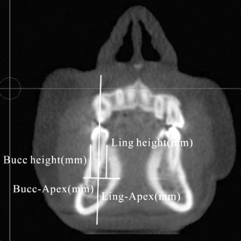 Angle Between The Axis And The Buccal Cortex Premo Axbucc Cort And