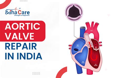 Aortic Valve Repair In India Healthcare Blogs Get Medical Updates