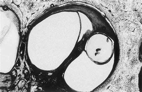 Histologic Slide Showing Nucleus Contour Electrode Inserted Into The